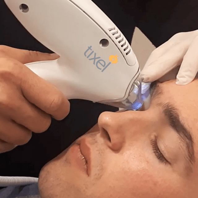 Tixel: Revolutionizing Dry Eye Relief with Cutting-Edge Technology ...