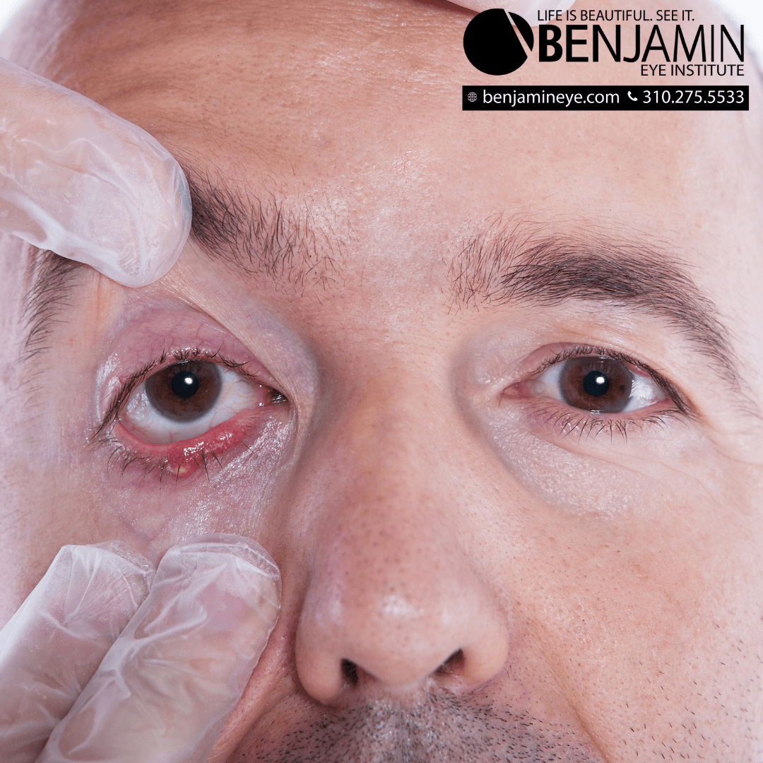 The Truth About Stye Removal: Why Professional Treatment is Crucial ...