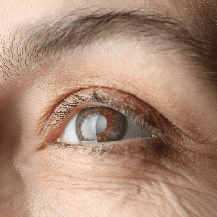 5 common myths about Cataract Surgery | Benjamin Eye Institute